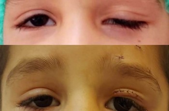 Blepharoplasty Eyelid Aesthetics